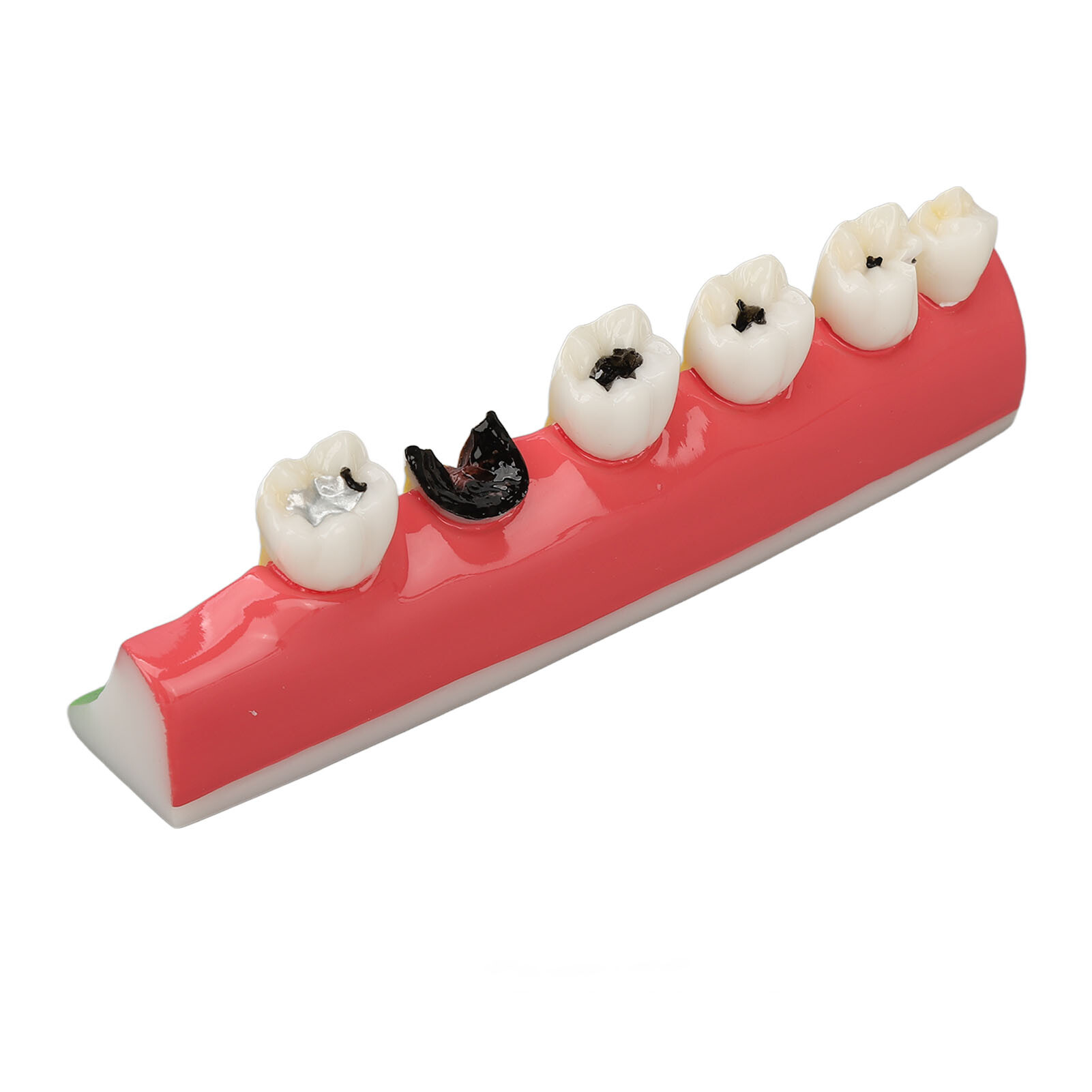 Dental Caries Model 6 Stages Resin Tooth Decay Display Dental Anatomy ...