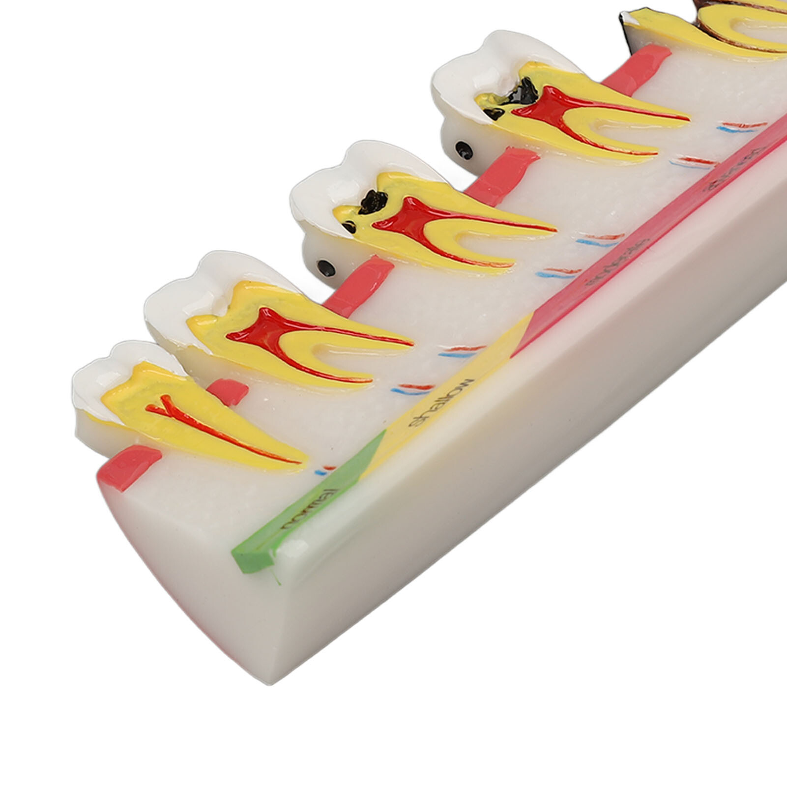 Dental Caries Model 6 Stages Resin Tooth Decay Display Dental Anatomy ...
