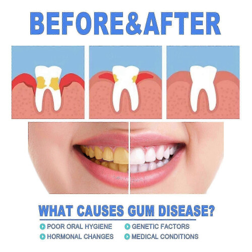 (3pcs) Gum Shield Gel - Advanced Gum Treatment & Disease Management ...